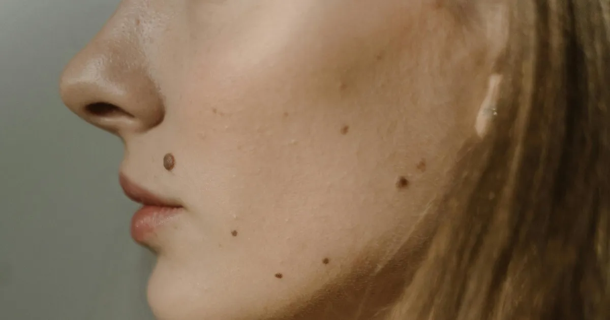 Immune system plays a role in mole formation and melanoma risk