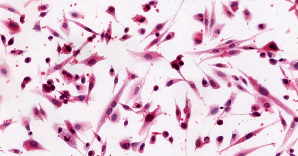 Brain Cancer Cells Under Microscope