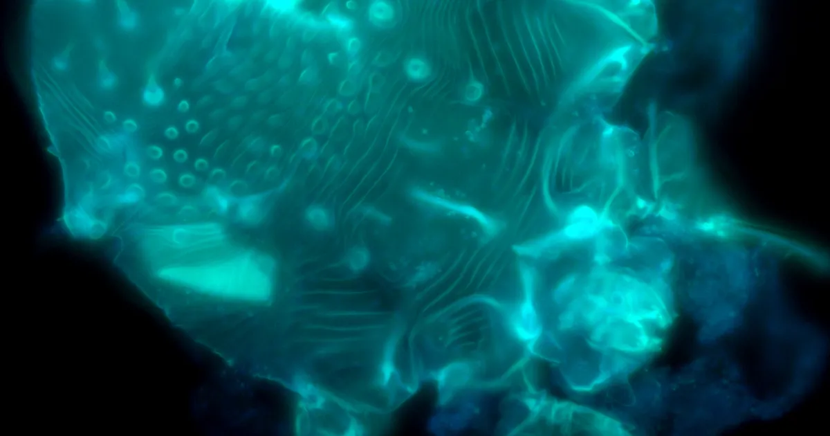 Scabies and Associated Bacterial Infections