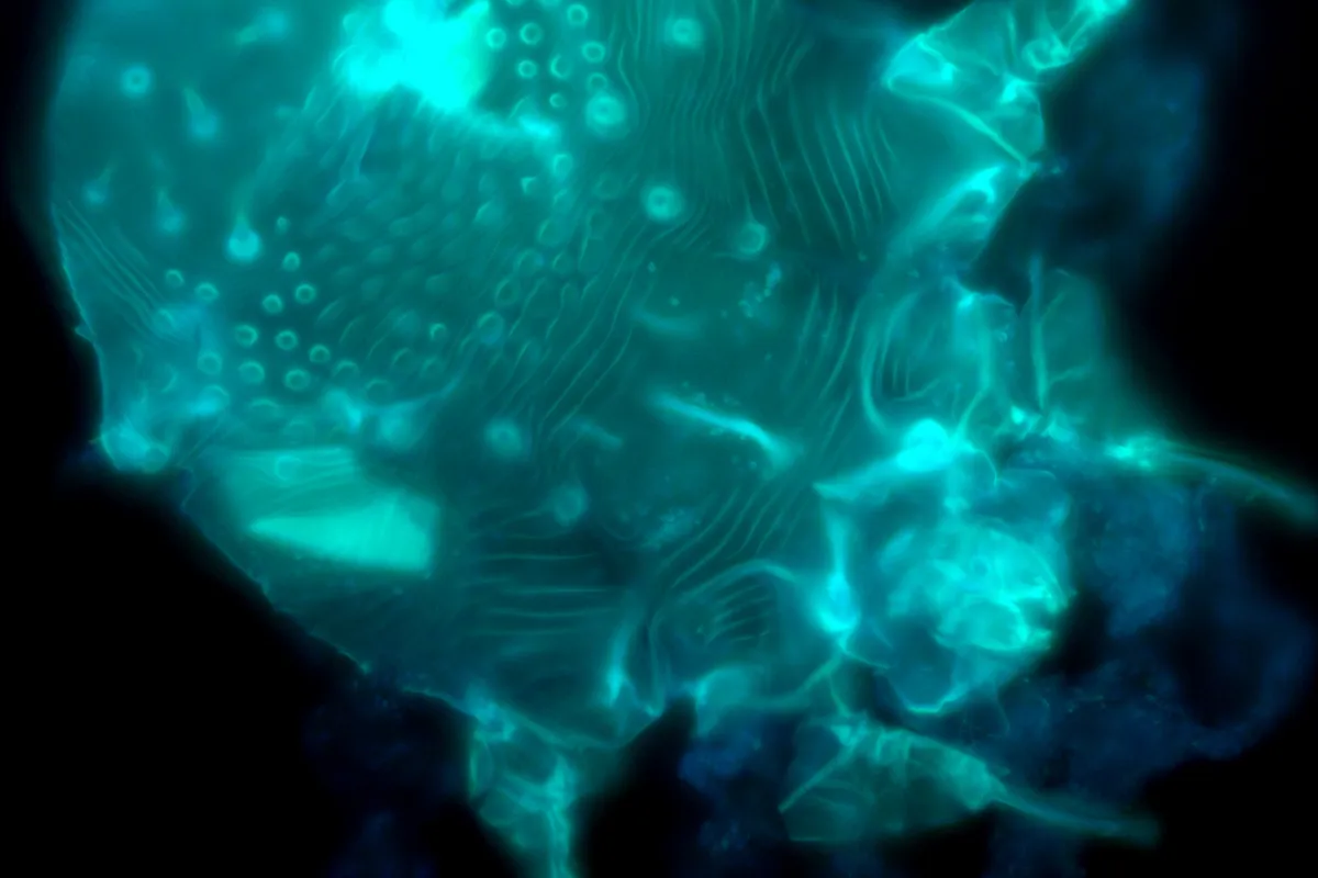 Scabies and Associated Bacterial Infections